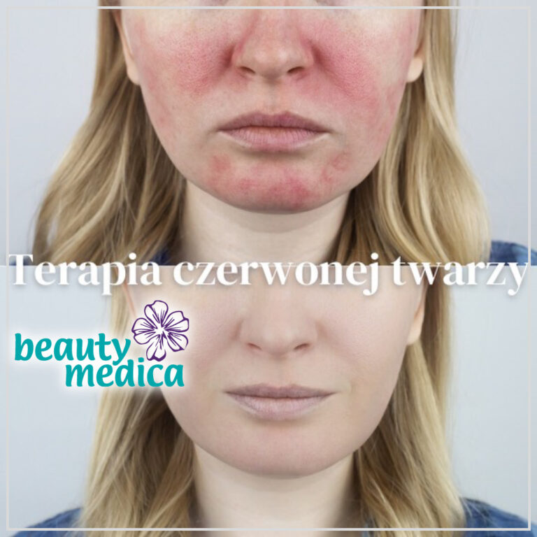 TRĄDZIK RÓŻOWATY - LECZENIE LASEREM BEZ ANTYBIOTYKOTERAPII - Toruń ...